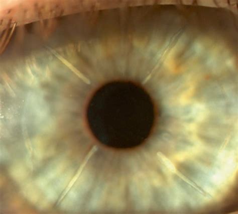 Astigmatic Keratotomy