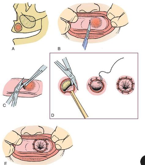 Marsupialization Technique Medizzy