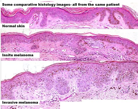 Introduction To Dermatoscopy
