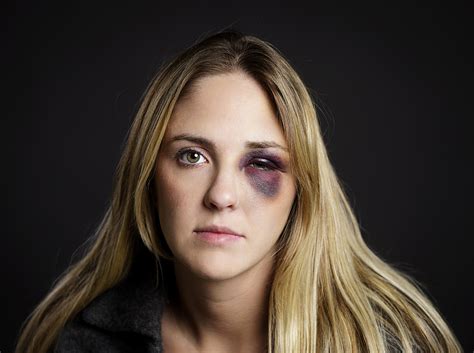 Картинка Подбитый Глаз – Telegraph