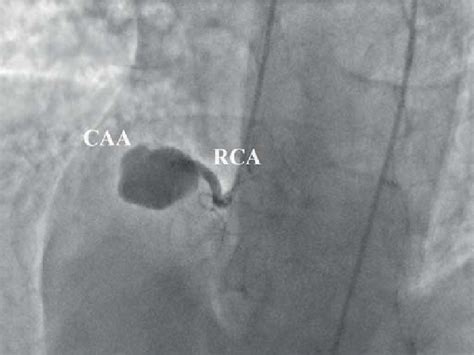 A Radiography Of The Rca Findings Show Occlusions Of Both The Caa And Download Scientific