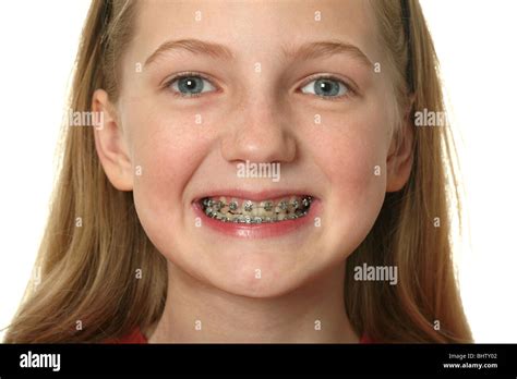 Young Girl With Dental Braces On Her Teeth Isolated On White Stock