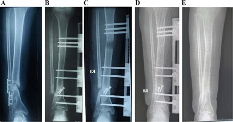 Male Years Old With Infected Non Union Of Right Distal Tibia A Download Scientific Diagram