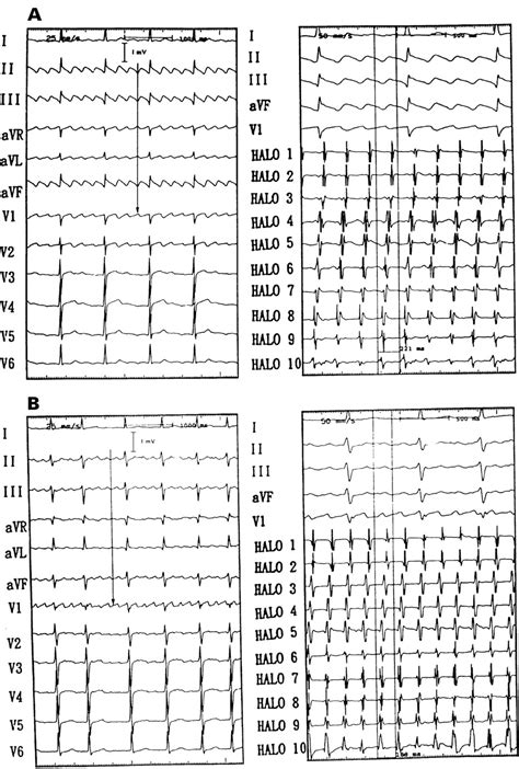 New Electrocardiographic Criteria For The Differentiation Between