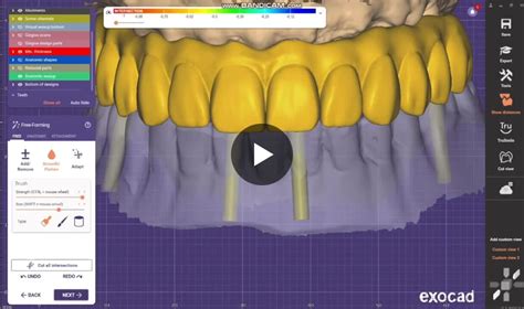 Design All On X Design Exocad