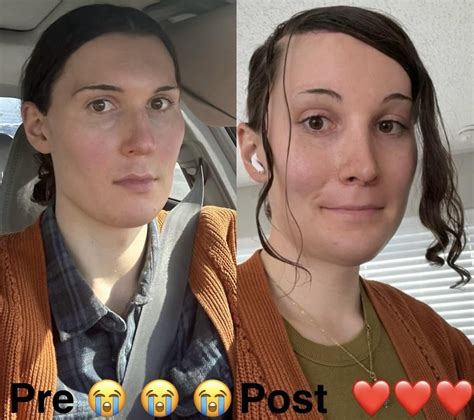 4 Days Pre Ffs Vs 30 Days Later Rtranstimelines