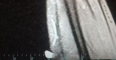 Retained Wooden Foreign Body