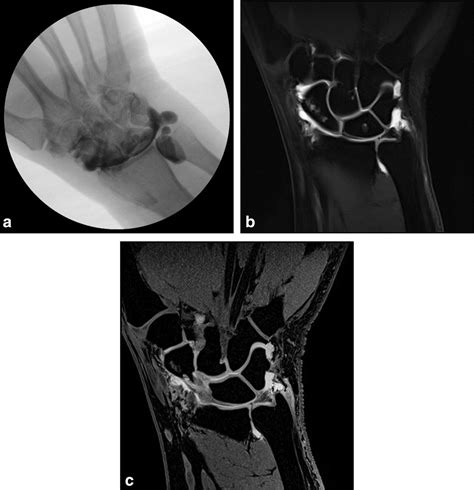 Magnetic Resonance Imaging Of Triangular Fibrocartilage Yoshioka 2012 Journal Of Magnetic