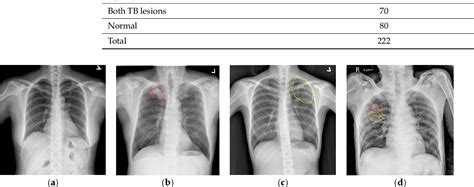 Figure 6 From Deep Learning Based Classification And Semantic Segmentation Of Lung Tuberculosis