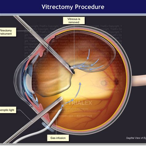 Vitrectomy Procedure Trialexhibits Inc