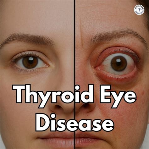 Thyroid Eye Disease Symptoms Causes And Treatment Explained
