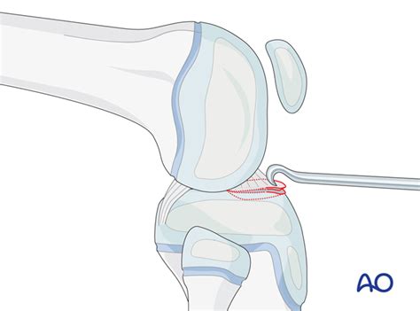 Open Reduction Screw Fixation For Avulsion Of The Tibial Spine