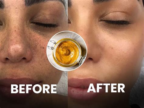 How to remove pimples सतत पपलस यतत कळ डगह पडतत घरच य पदधतन हळद लवन मळव