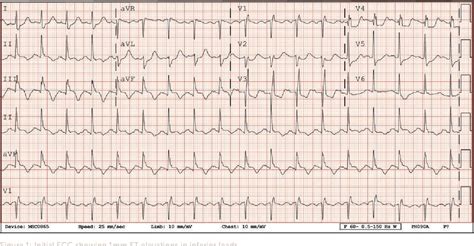 Figure 1 From Interventricular Septum Rupture In The Catheterization