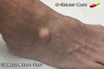 Ganglion Cyst Foot Surgery Alternative G Relief Caps 100 Natural Relief