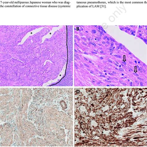 A Microscopic Section Of Pelvic Lymph Node Under Low Power Showing Download Scientific Diagram