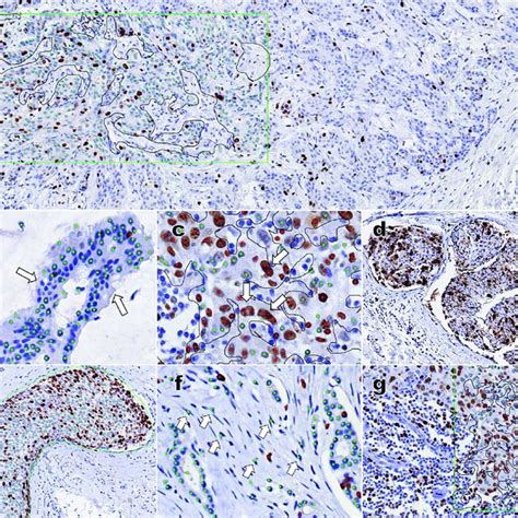 The Causes Of Discrepancy Between Two Visual Assessment And Automated Download Scientific
