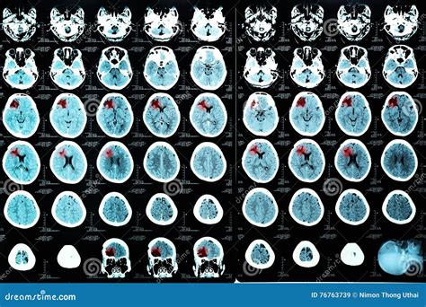 Images From A Computerized Tomography Of The Brain Royalty Free Stock