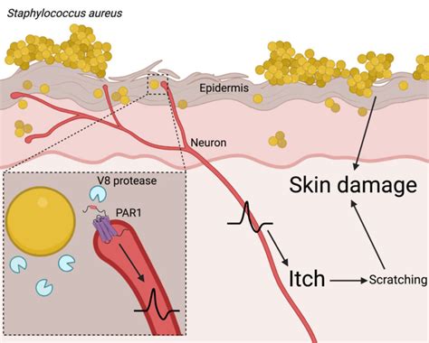 Effect Of Staphylococcus Aureus Colonization And Immune Defects On The
