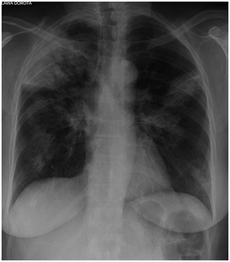 Organizing Pneumonia Cryptogenic Organising Pneumonia European