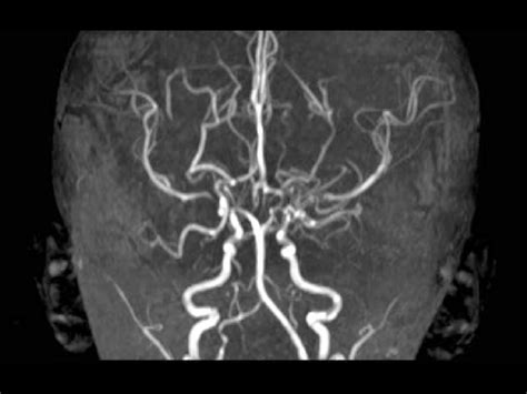 Three Dimensional 3d Magnetic Resonance Angiography Mra Shows