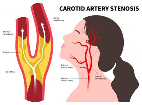 Recent Updates In The Treatment Of Carotid Artery Stenosis Vascular