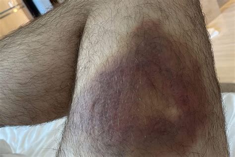 Life As An Mlb Catcher Violet Bruises Ballooned Ankles — And Now