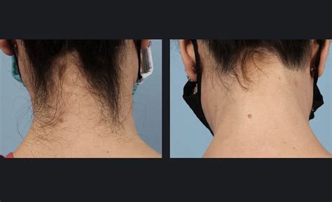 Patient Laser Hair Removal Candela Medical