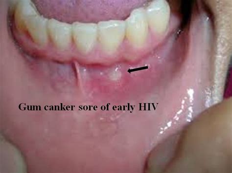 Early Or “acute” Hiv Mouth Sores Pictures
