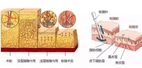 杭州维多利亚抽脂医生介绍推荐马腾俞国宝医生吸脂技术好吸脂对比照 8682整形网