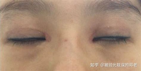 视疲劳案例分享 知乎
