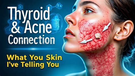 Thyroid Gland Acne Causes Symptoms And Treatments