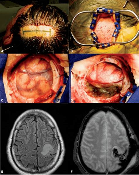 Standard Approach To Brain Tumor In The Motor Cortex A 56 Year Old