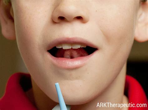 Tongue Tip Elevation Exercises Ark Products Llc