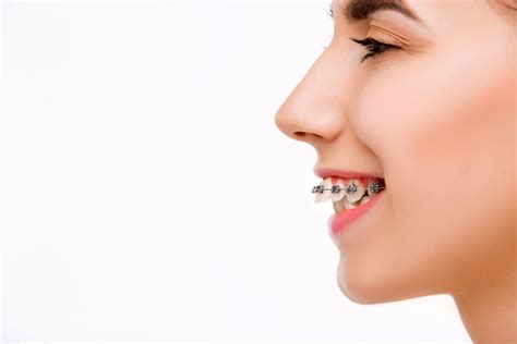 Why Should I Correct My Overbite Ortega Orthodontics