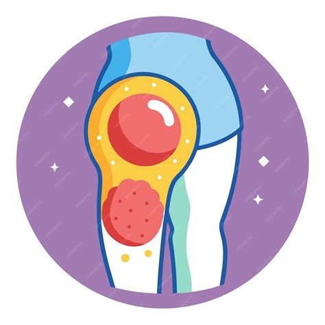 Bakers Cyst In The Knee Clip Art And Vector Design With A White