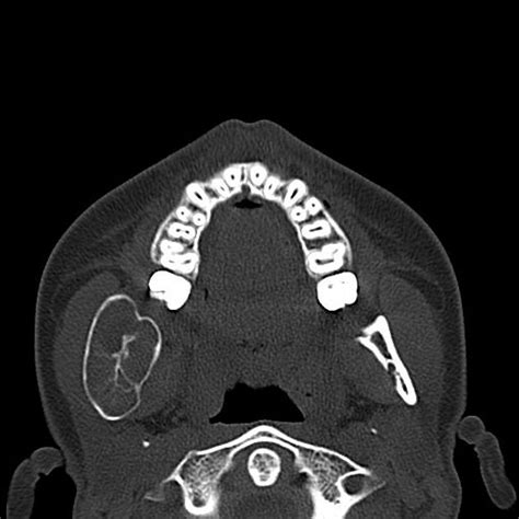 Aneurysmal Bone Cyst Jaw Aneurysmal Bone Cyst Jaw