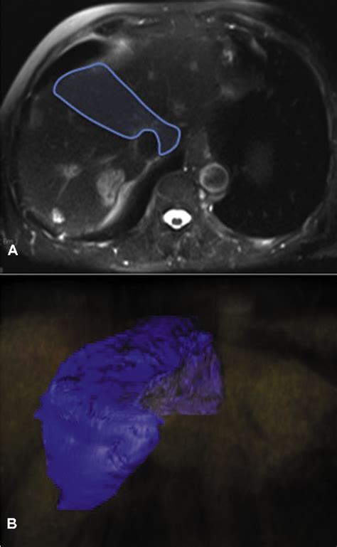 Pdf The Associating Liver Partition And Portal Vein Ligation For Staged Hepatectomy Approach