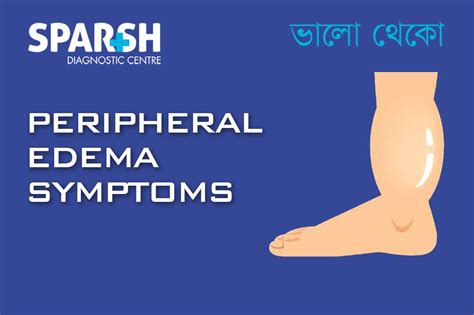 Peripheral Edema Causes Symptoms Treatment And When To Worry Sparsh