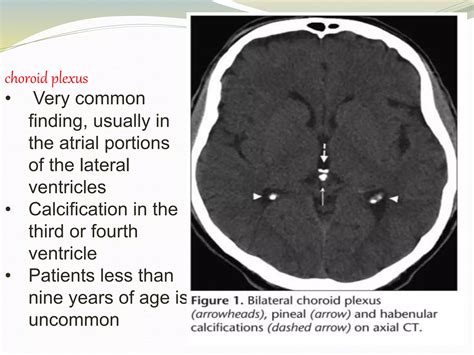 Physiological And Pathological Calcification Of Brain Pptx