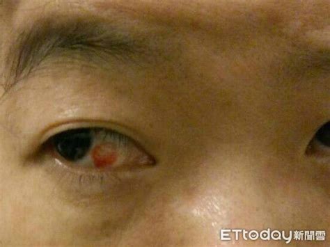 眼白出血卻不痛？醫：4狀況害的 揉眼睛「更易讓血管破裂」 Ettoday健康雲 Ettoday新聞雲