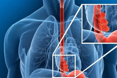 Cancer De Esofago Esperanza De Vida ¡tratamiento A Seguir Enelbreak
