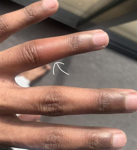 Are These Chilblains R Raynauds