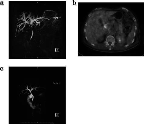 A Cholangiography With MRCP Shows Bile Duct Stenosis Before The Download Scientific Diagram