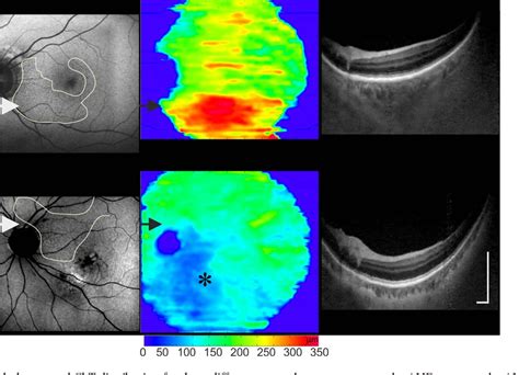 Figure 2 From Choroidal Thickness In Patients With Reticular Pseudodrusen Using 3d 1060 Nm Oct