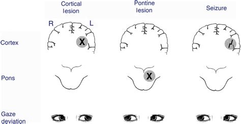 Eye Movement Disorders Conjugate Gaze Abnormalities Ento Key