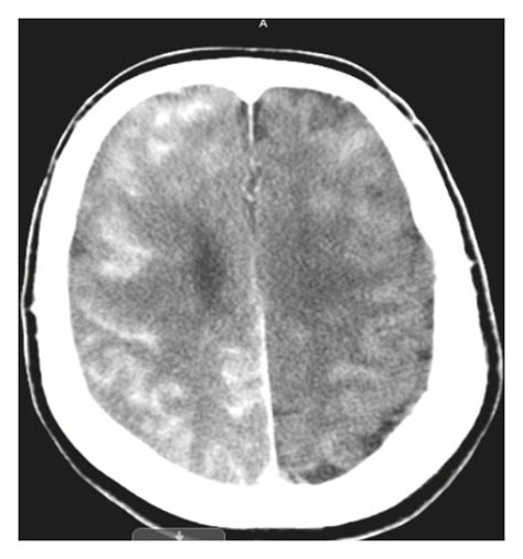 Ct Brain Showing Increased Hyperdensity And Enhancement Of Right Cortex Download Scientific