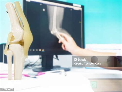 의학 교육을위한 흰색 테이블에 청진기가있는 인간의 무릎과 다리의 모델과 클리닉의 Lcd Mornitor에 X 선 무릎 의학 교육 이미지 개념 X 레이에 대한 스톡 사진 및