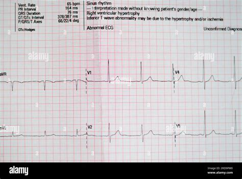 Ecg Electrocardiograph Paper That Shows Sinus Rhythm Abnormality Of Right Ventricular