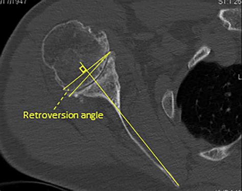 Retroversion Angle Measured Between The Longitudinal Axis Of The Download Scientific Diagram